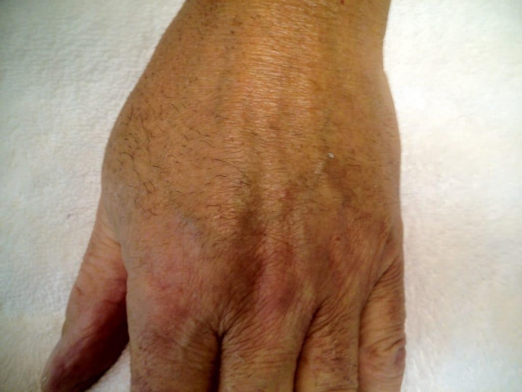 Ageing Hands Treatment | Solihull Medical Cosmetic Clinic