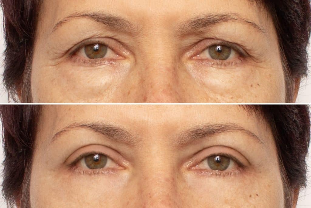 Non-Surgical Eyelid Lift | Solihull Cosmetic Clinic